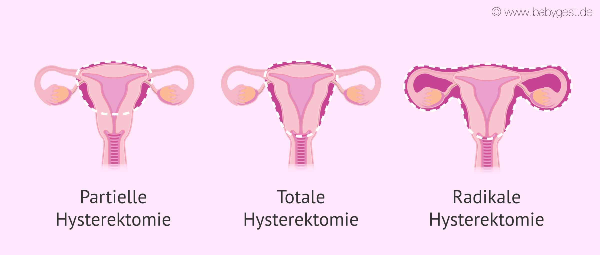 Endometriose - Adenomyose
